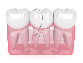 Broken Crown Tooth | Sure Smile Dental Care